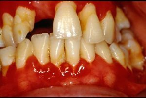GINGIVITIS - Microbiology Class