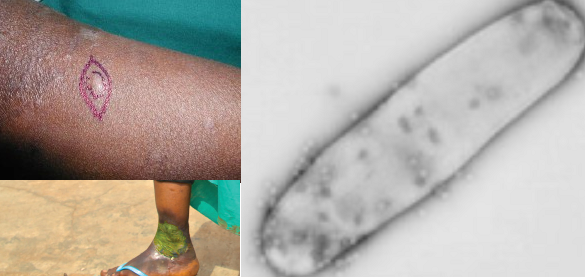 Buruli ulcer (Mycobacterium ulcerans infection) Archives - Everything ...