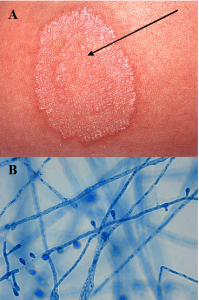 CUTANEOUS MYCOSES - Microbiology Class