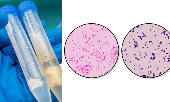 GRAM SMEAR OF CEREBROSPINAL FLUID (CSF) SAMPLE Archives - Everything ...