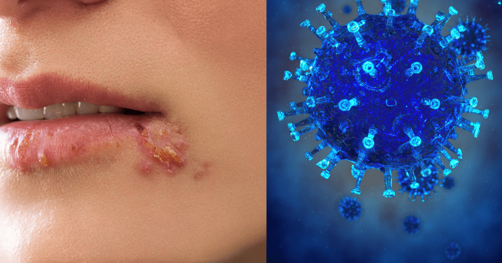 Herpes Virus Infections Archives - Microbiology Class